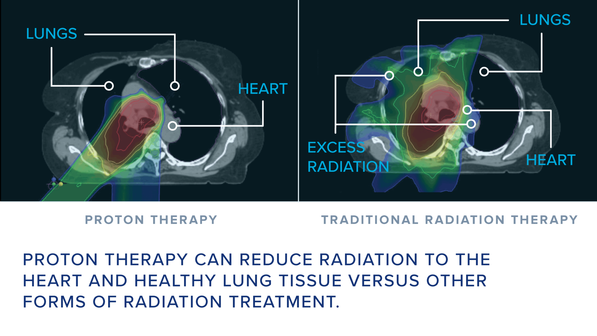 Lung Cancer Proton Therapy in OKC - Oklahoma Proton Center