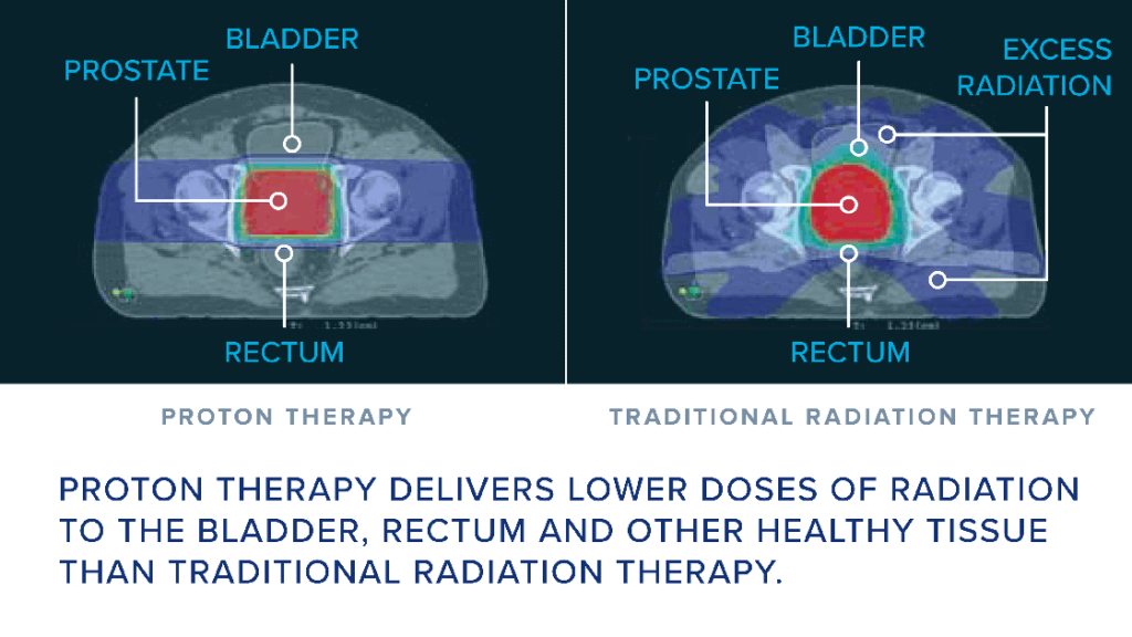 Prostate Cancer Proton Therapy Oklahoma Proton Center Prostate Cancer Proton Therapy Oklahoma Proton Center