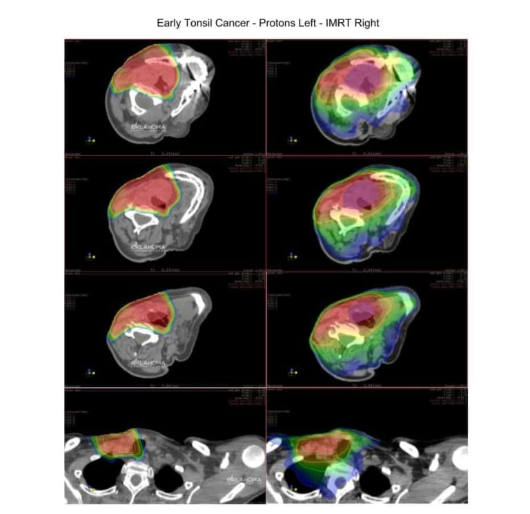 Protons vs IMRT - Oklahoma Proton Center