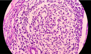 Biopsy - Prostate Cancer - Oklahoma Proton Center